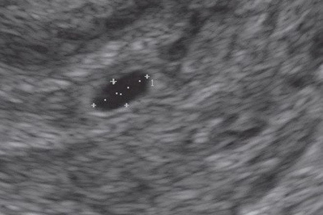 Week-by-week pregnancy scan photos - Netmums