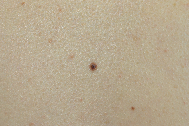 Skin cancer: what you should really be looking for - Netmums