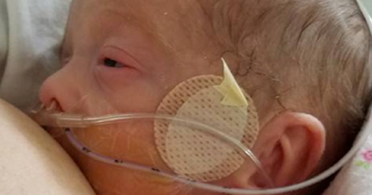 The beautiful photo of a premature baby breastfeeding - Netmums